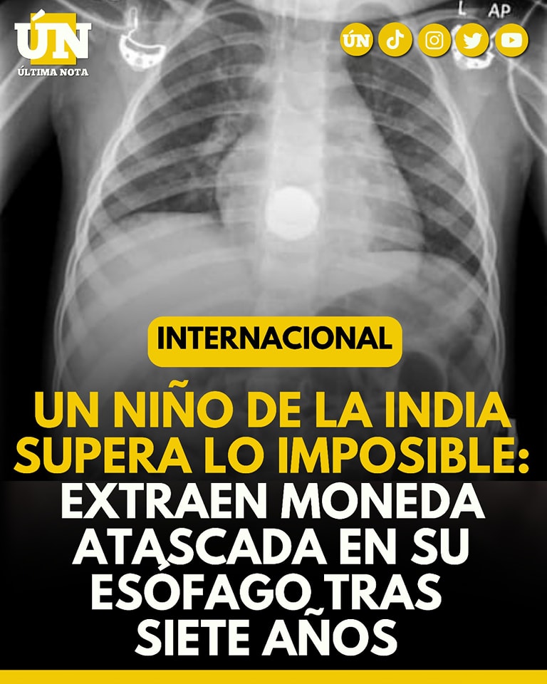 Un Niño Supera lo Imposible: Extraen Moneda Atascada en su Esófago tras ...
